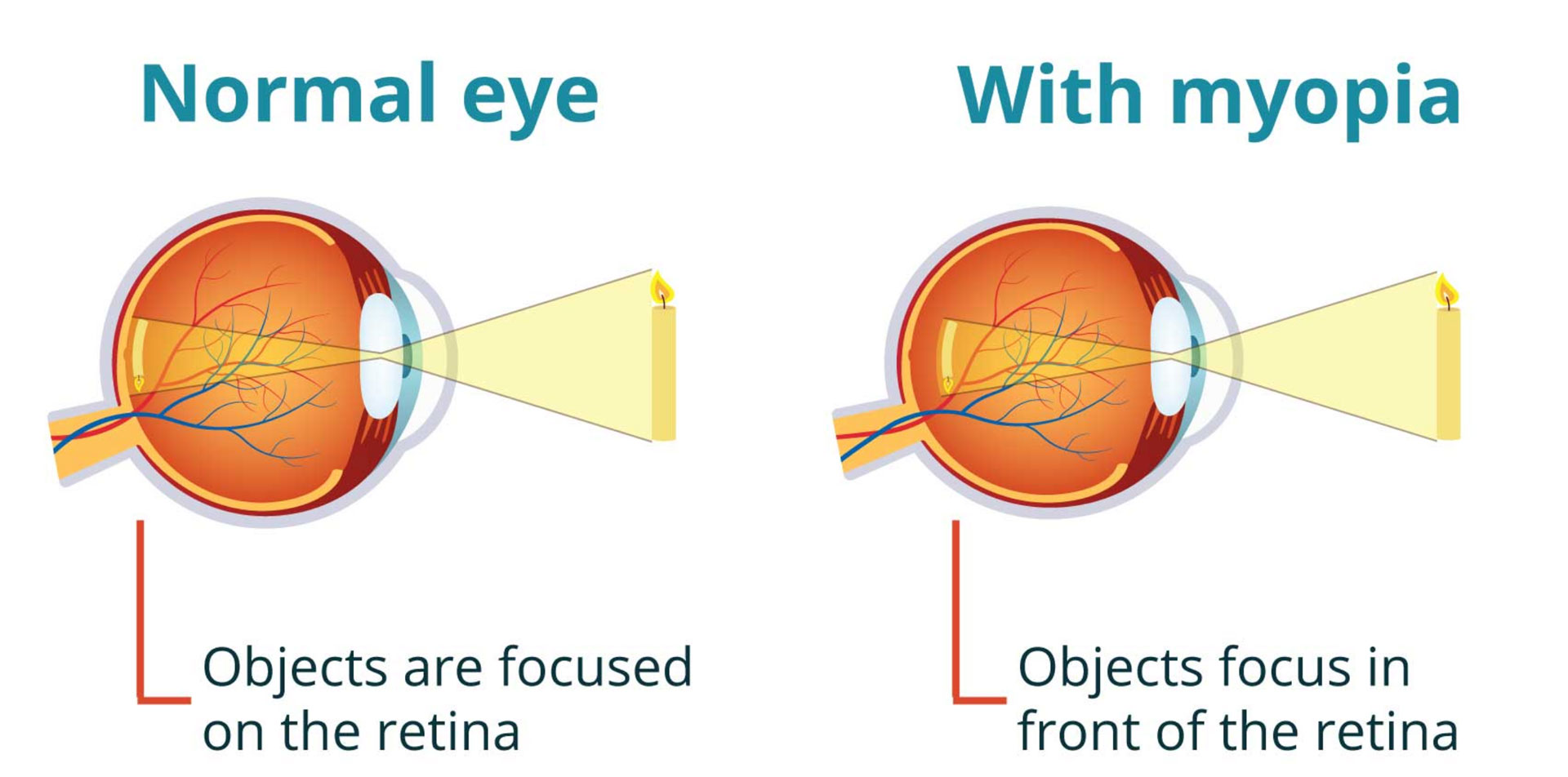 Myopia Management - James Wood Eyecare Gateshead